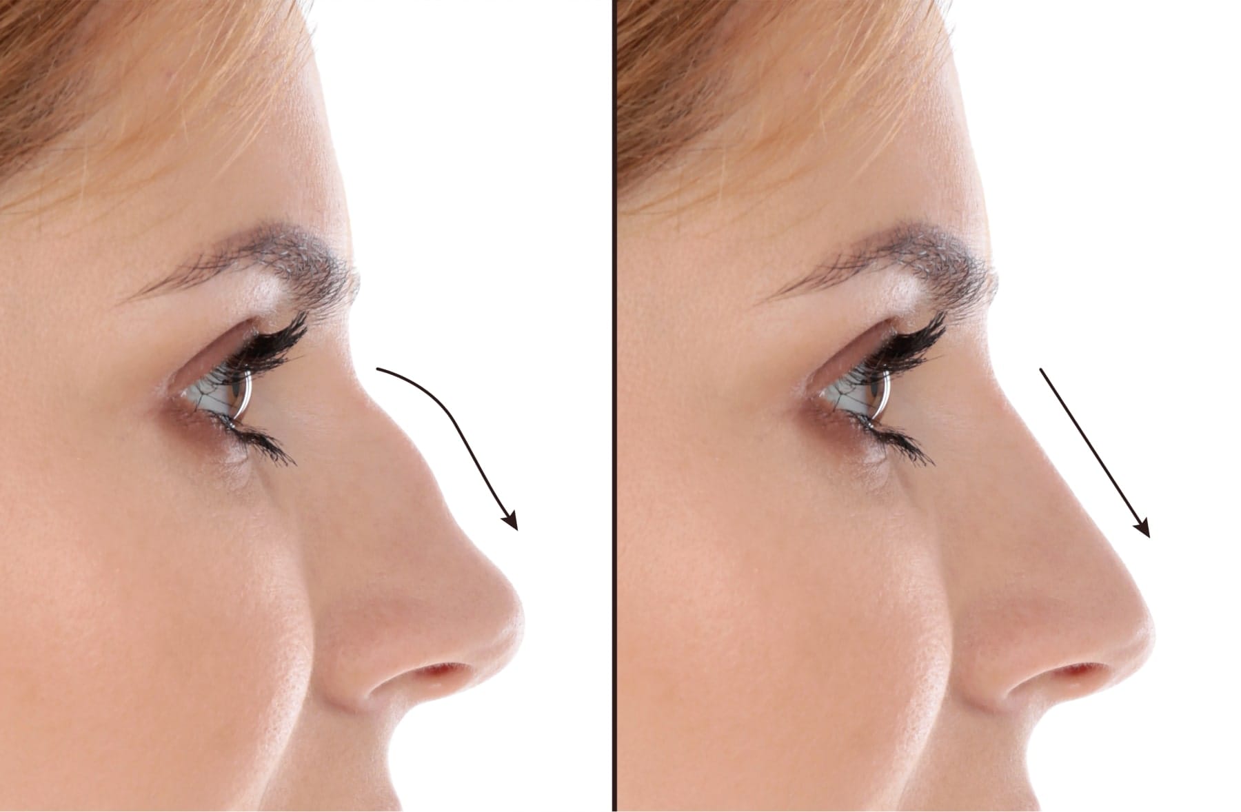 Nose Fillers - Gold Coast Aesthetics