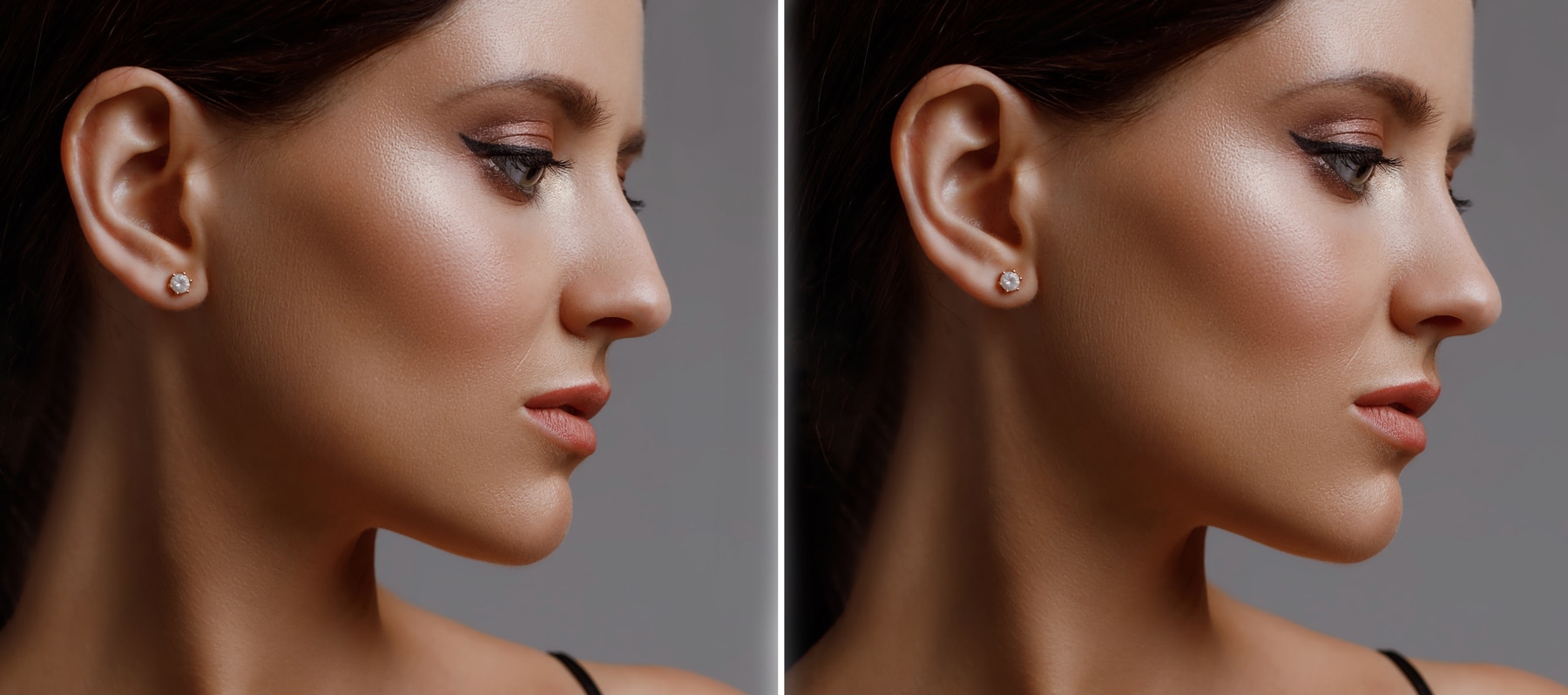 Nose Fillers - Gold Coast Aesthetics