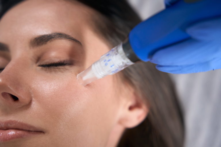 How Much Does SkinPen Microneedling Cost? - Gold Coast Aesthetics